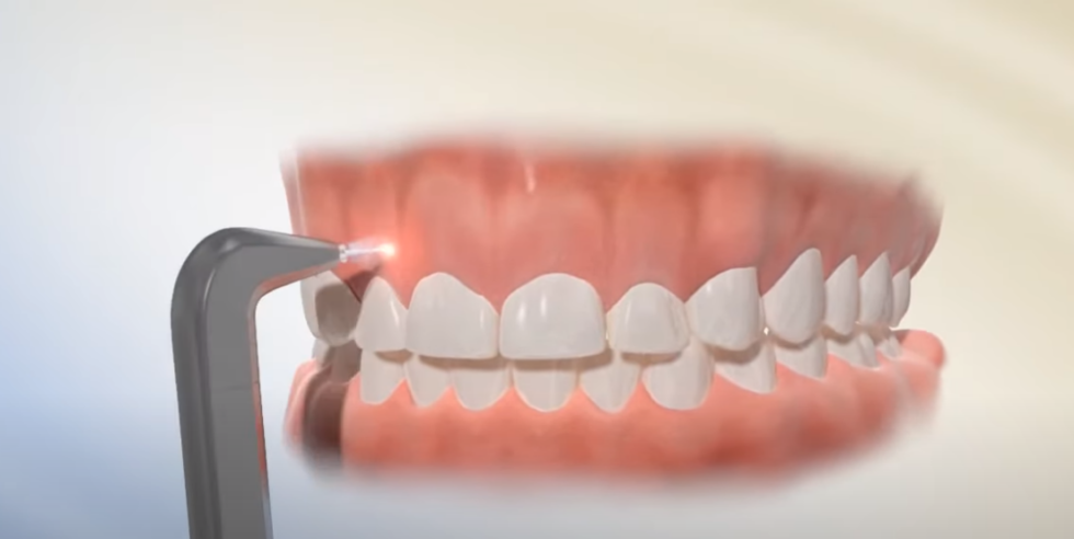 Laser Gum Surgery in San Antonio | Hernandez Dental