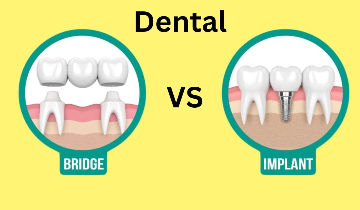 Dental Bridge vs Implant in San Antonio TX: Which Is Best?