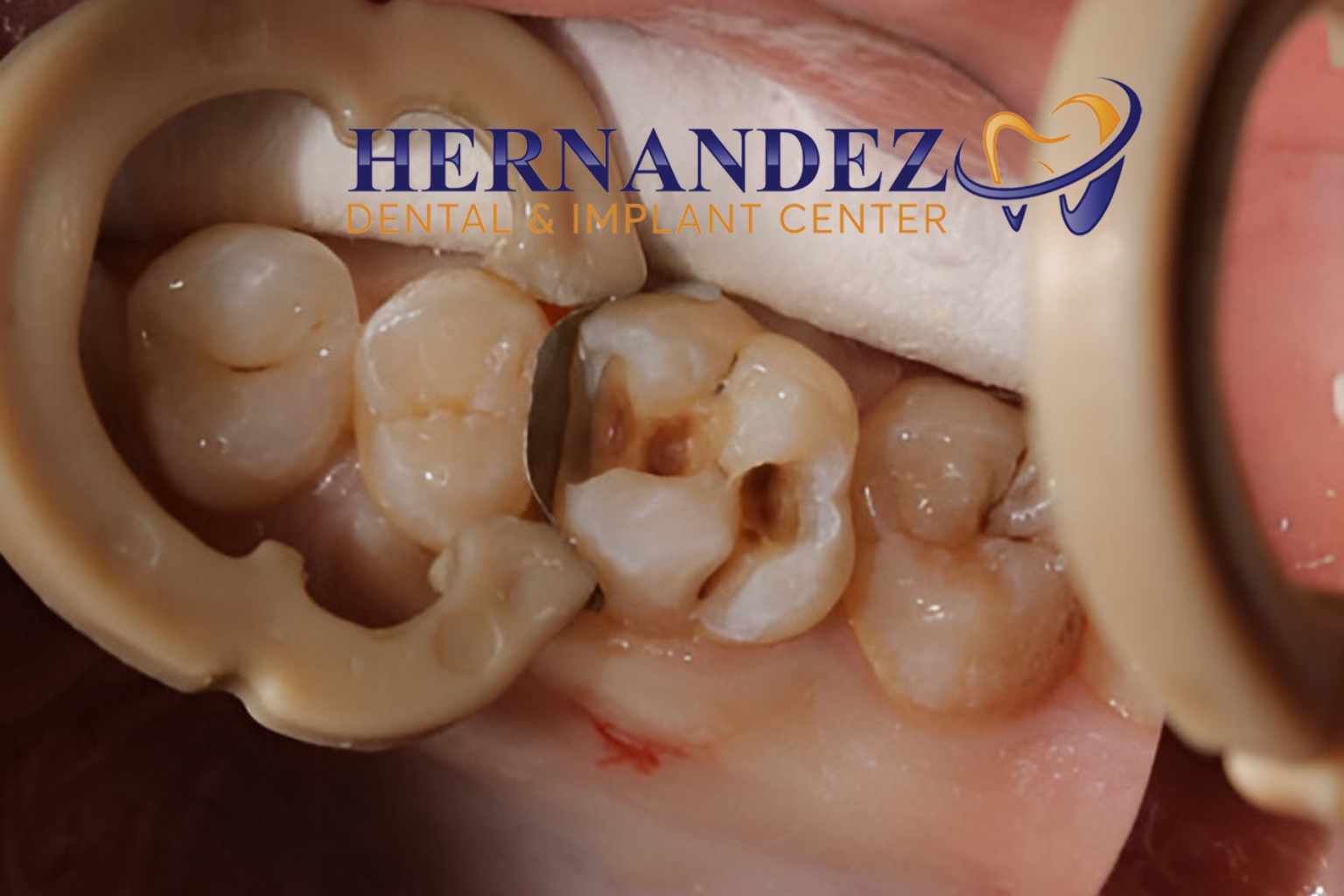 Infection After A Tooth Extraction: Painful Signs You Shouldn't Ignore ...