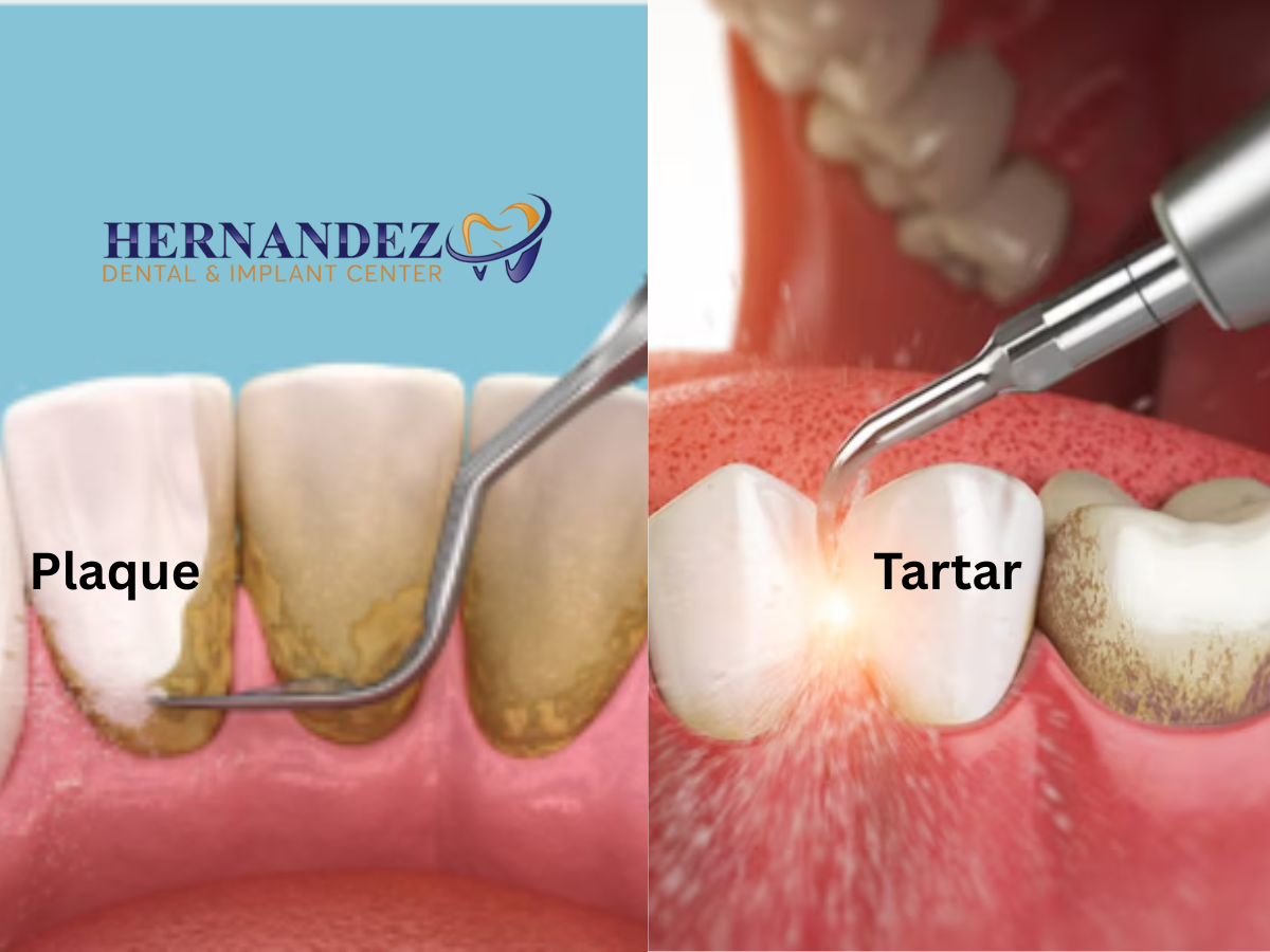 Plaque Vs Tartar: What's The Difference?